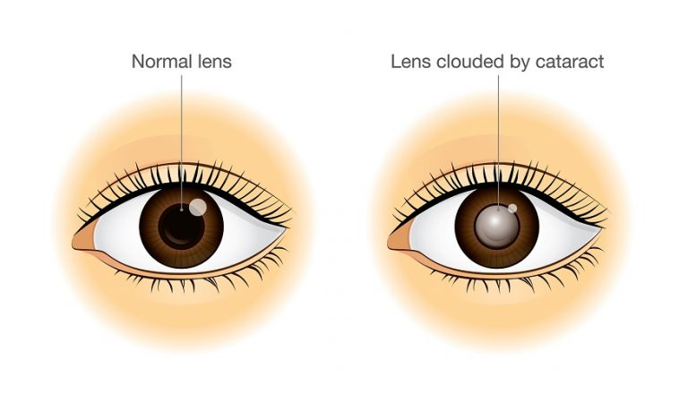 How to Prevent Cataracts – Mojo Health